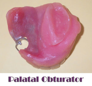 Palatal Obturator