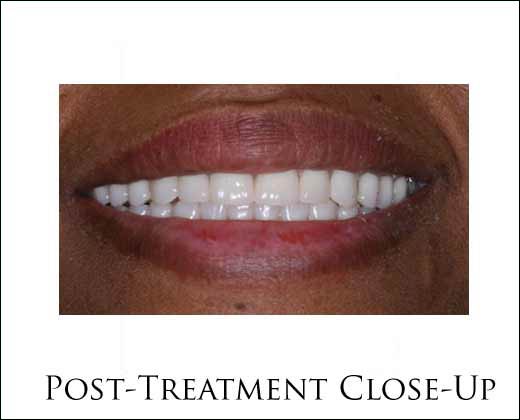 Lower Arch Teeth In A Day