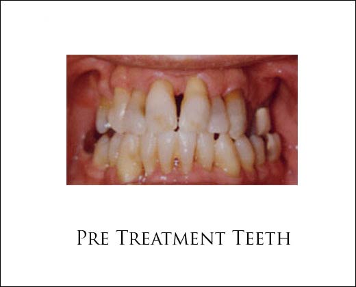 Replacing Periodontally Compromised Teeth | Pi Dental Center