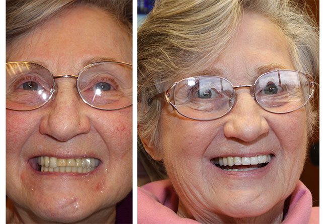 Zirconia Crowns for Front Teeth | Pi Dental Center