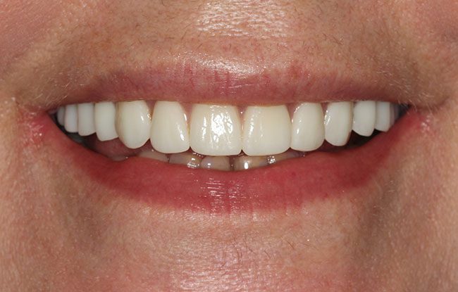 Happy Teeth Smile