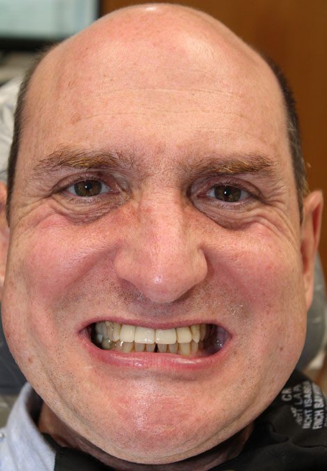 Single Tooth Restoration | Pi Dental Center, Fort Washington, PA